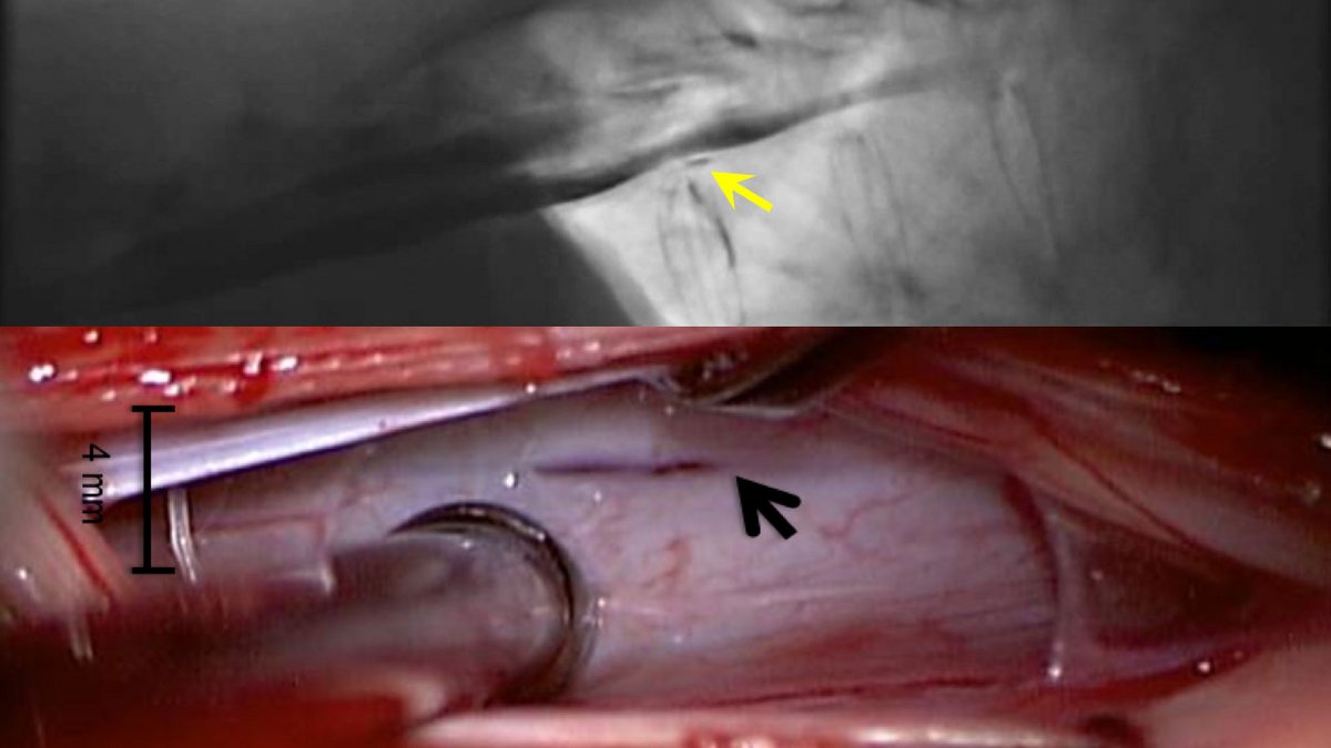 Cerebrospinal fluid leak | Neurosurgery Inselspital Bern