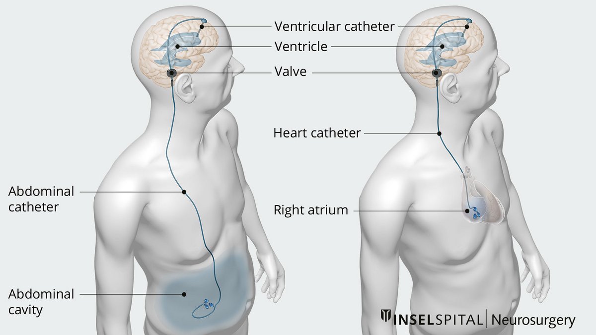 Normal Pressure Hydrocephalus Neurosurgery Inselspital Bern Normal Pressure Hydrocephalus Neurosurgery Inselspital Bern