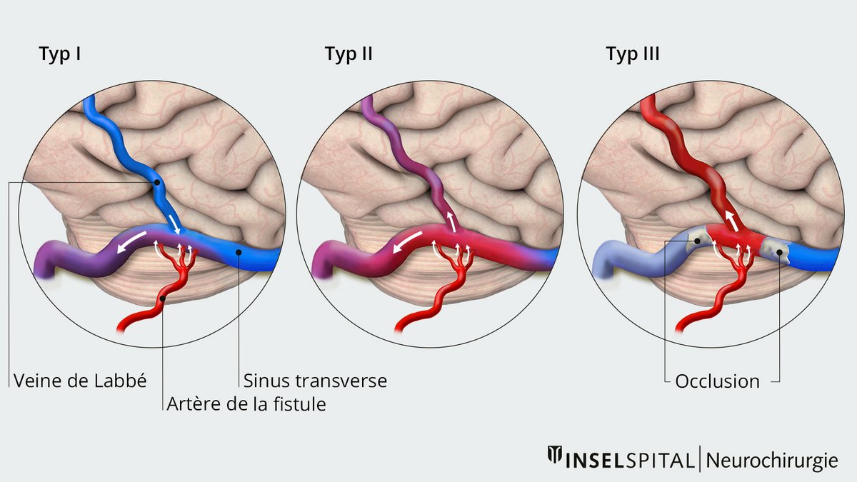 Fistules artério-veineuses durales | Neurochirurgie, Inselspital Bern