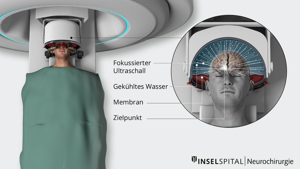 MR-guided focused ultrasound | Neurosurgery Inselspital Bern