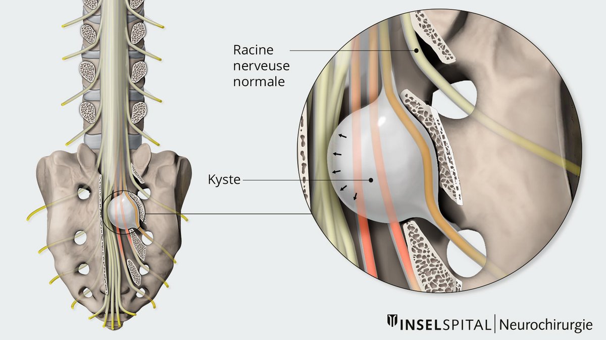 Kyste de Tarlov | Neurochirurgie Inselspital Bern