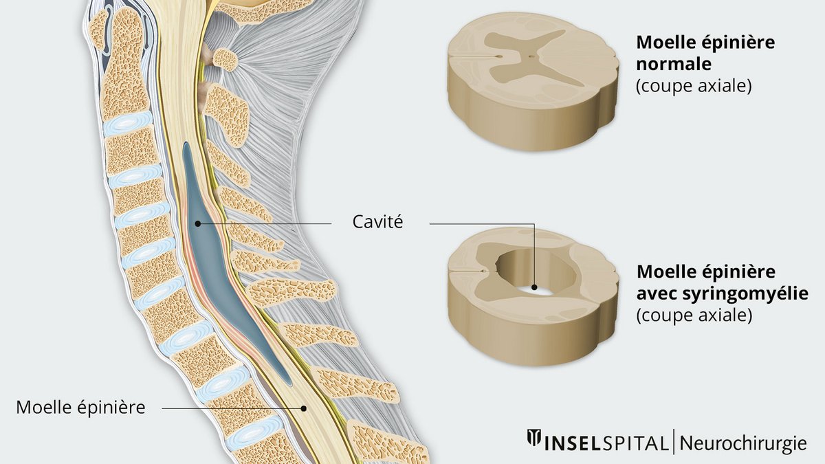 Syringomyélie | Neurochirurgie Inselspital Bern