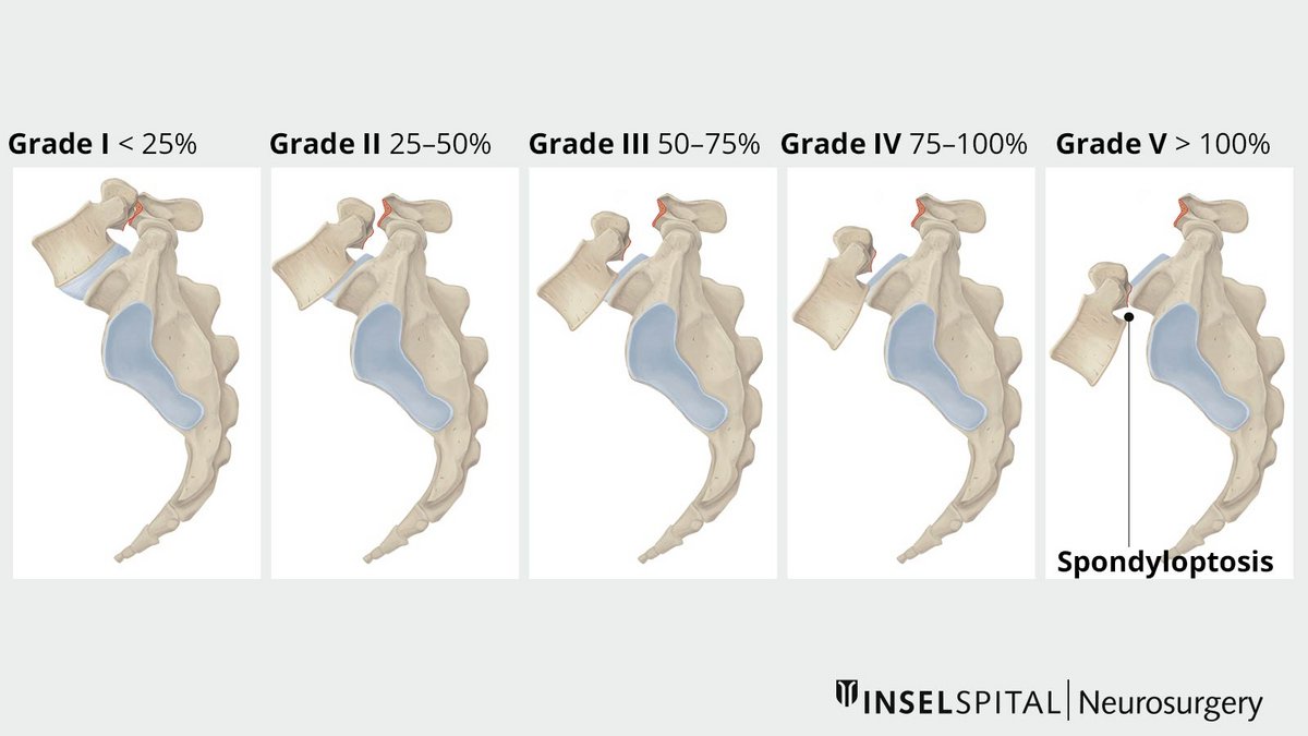 Spondylolisthesis | Neurosurgery Inselspital Bern